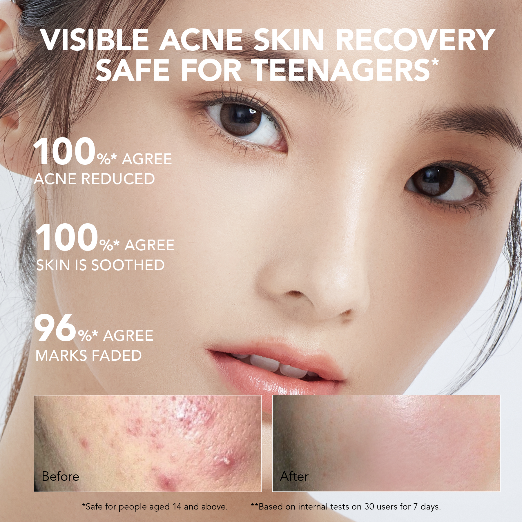 [LIVESTREAM EXCLUSIVE] YOU AcnePlus Acne Away Power Box 4 IN 1 SET ...