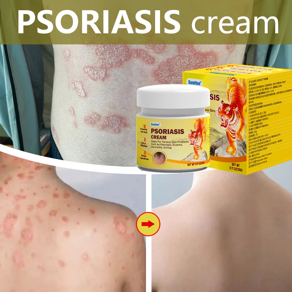 Herbal itchy Antibacterial Skin Cream Antifungal For Eczema Dermatitis ...