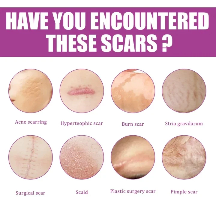 Scar Cream Nutrimoist Removal Eczema Burns Insect Bite Accident Wound ...