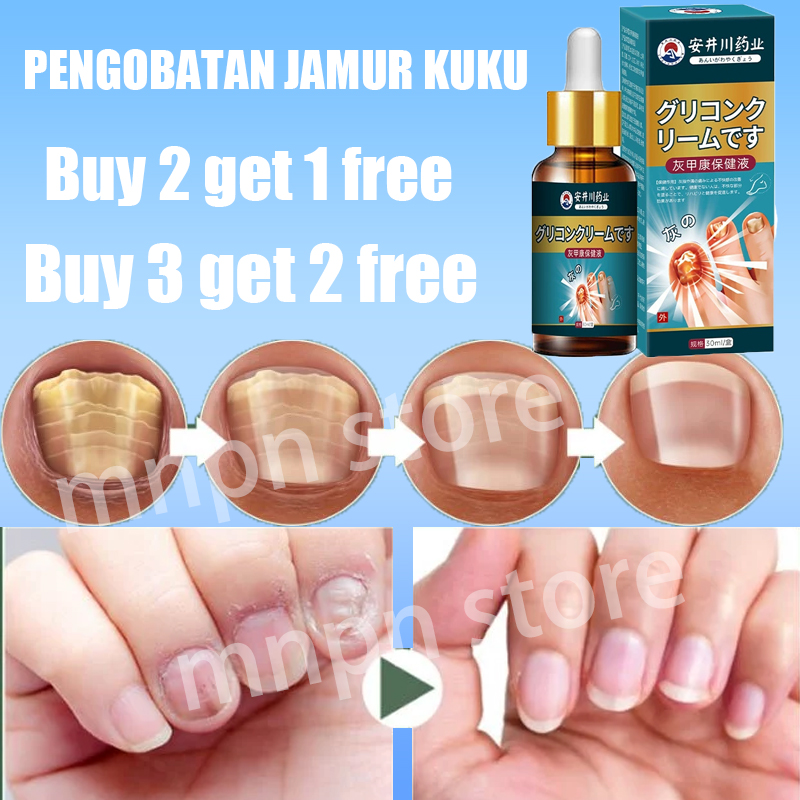 Japan ubat kuku rosak nail fungus treatment ubat kulat kuku ingrown ...