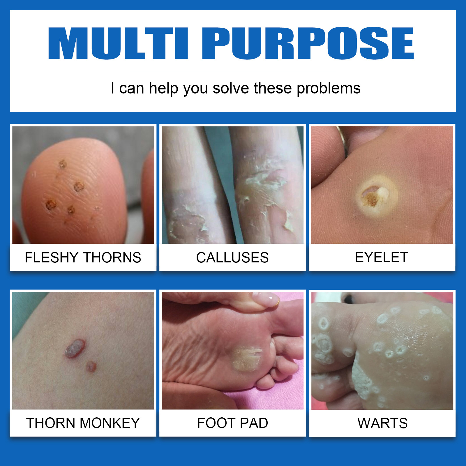 Ubat Ketuat Tapak Kaki Ubat Mata Ikan Penampal Ketuat Remover Foot Corn ...