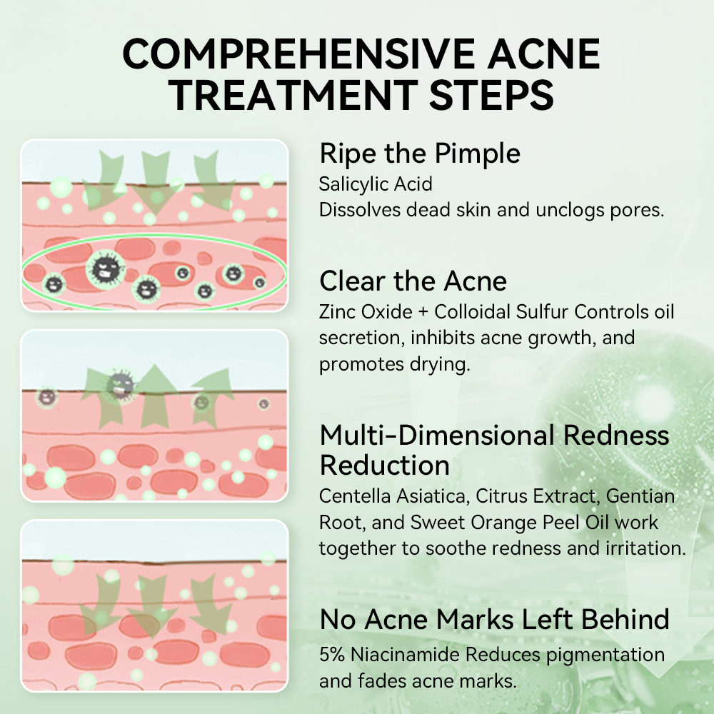 LANBENA Acne Essence Salicylic Acid Anti-acne Serum Acne Spot Treatment ...