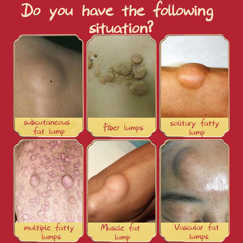 【COD】South Moon Lipoma Removal Cream Lipolysis Fat Lump Relieve Plaster ...