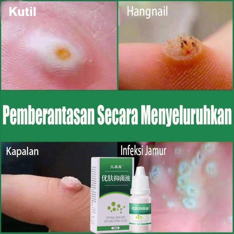 Wart Removal Treatmen Buang Kutil Corn and Calluse Quick Remover Get ...