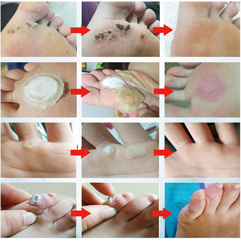 Ubat Ketuat Tapak Kaki Foot Corn Remover Corn Caps corn plaster remover ...