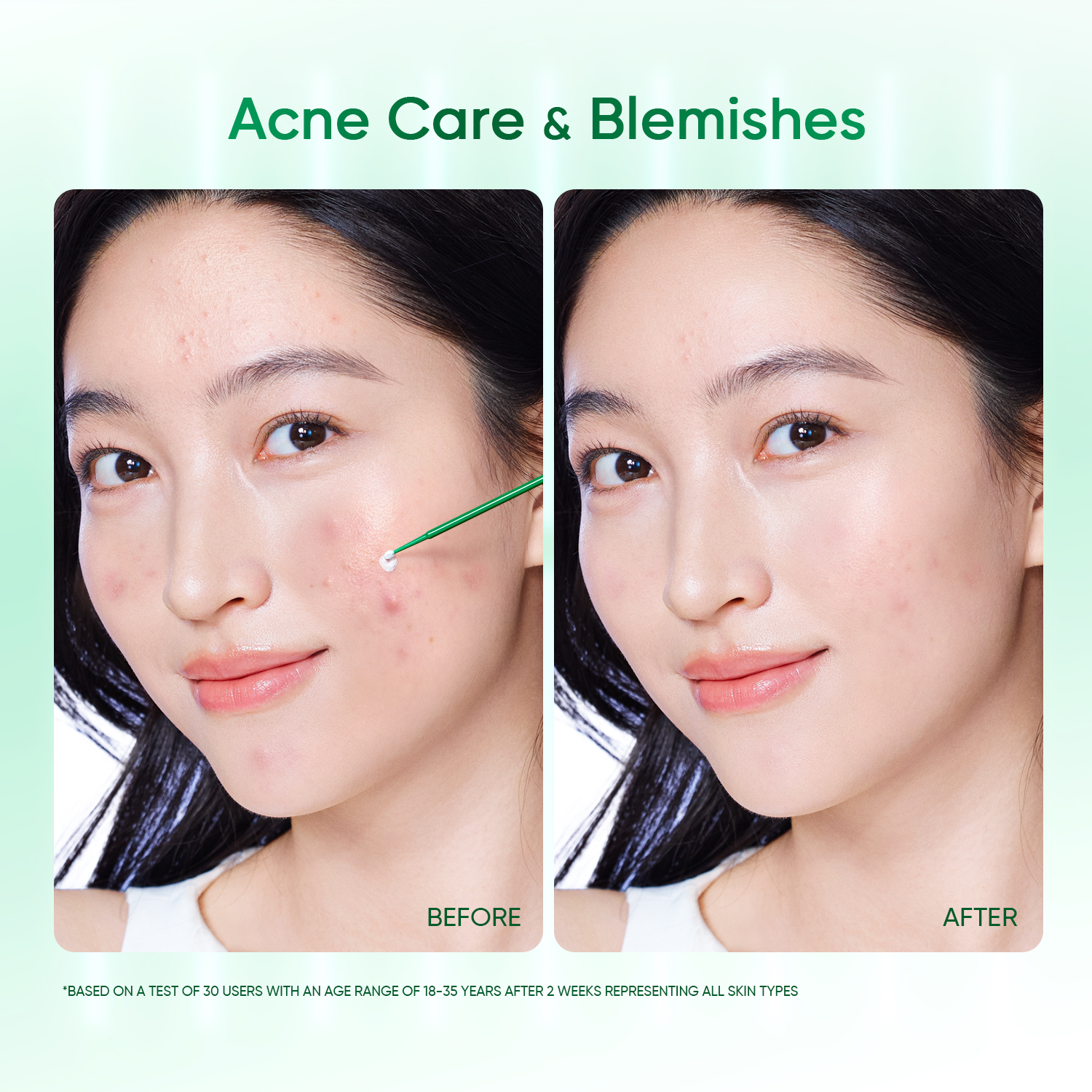 SKINTIFIC Acne Drying Lotion Salicylic Acid Anti-Acne Serum Acne Patch ...