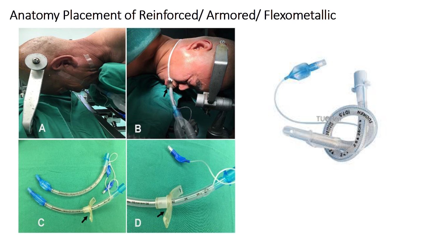 ENDOTRACHEAL TUBE REINFORCED CUFFED FLEXOMETALLIC ARMOURED TUBE CUFFED ...