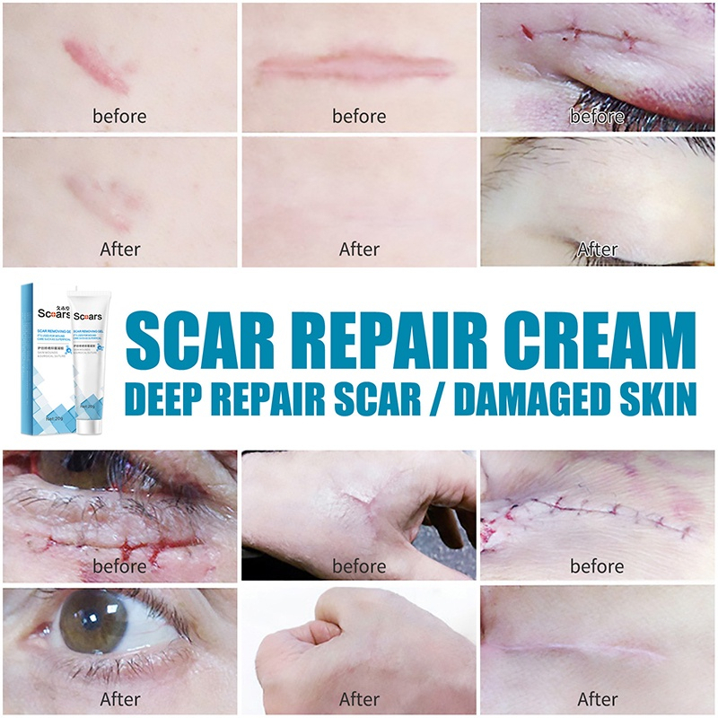 Scar Removal Cream 20g Treatment Remove Stretch Marks Burns Scald ...