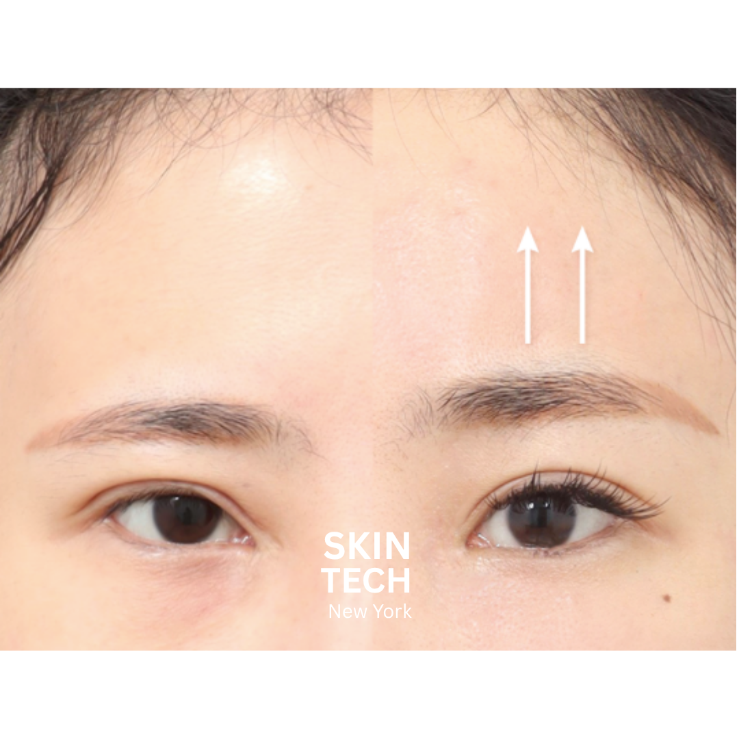 SkinTech Forehead Lifting Mask (1 Pack x 5 Pieces) | Shopee Malaysia
