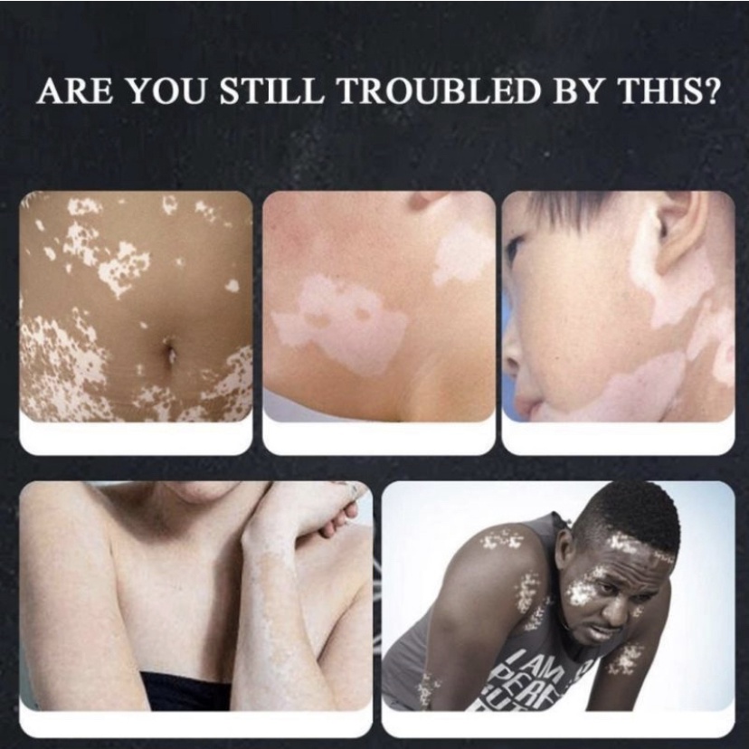 Vitiligo cream Krim White Spot Chinese Medical Pigment Panau Bintik ...