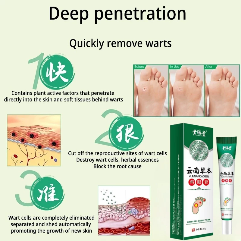 Foot corn removal, hand corn kernels removal, spines and plantar warts ...