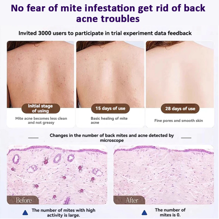 Back acne spray Acne spot treatment spray antibacterial Remove mites ...