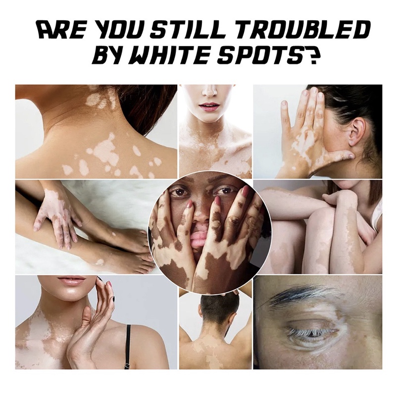 Vitiligo cream Krim White Spot Chinese Medical Pigment Panau Bintik ...
