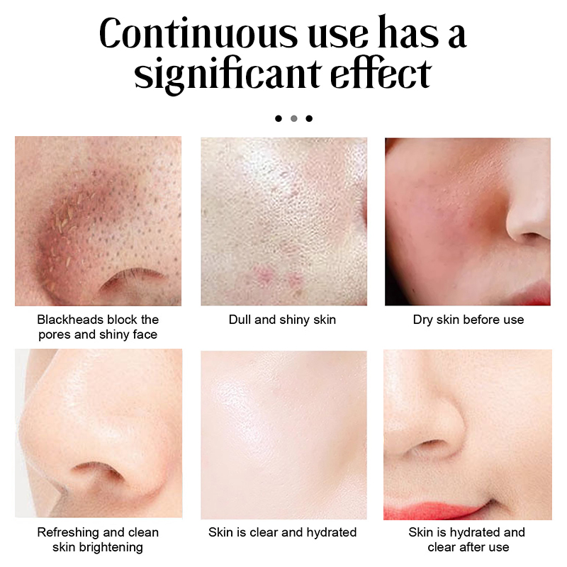 KOEC Blackhead Remover Nose Mask Deep Cleansing Mask Face Blackhead ...