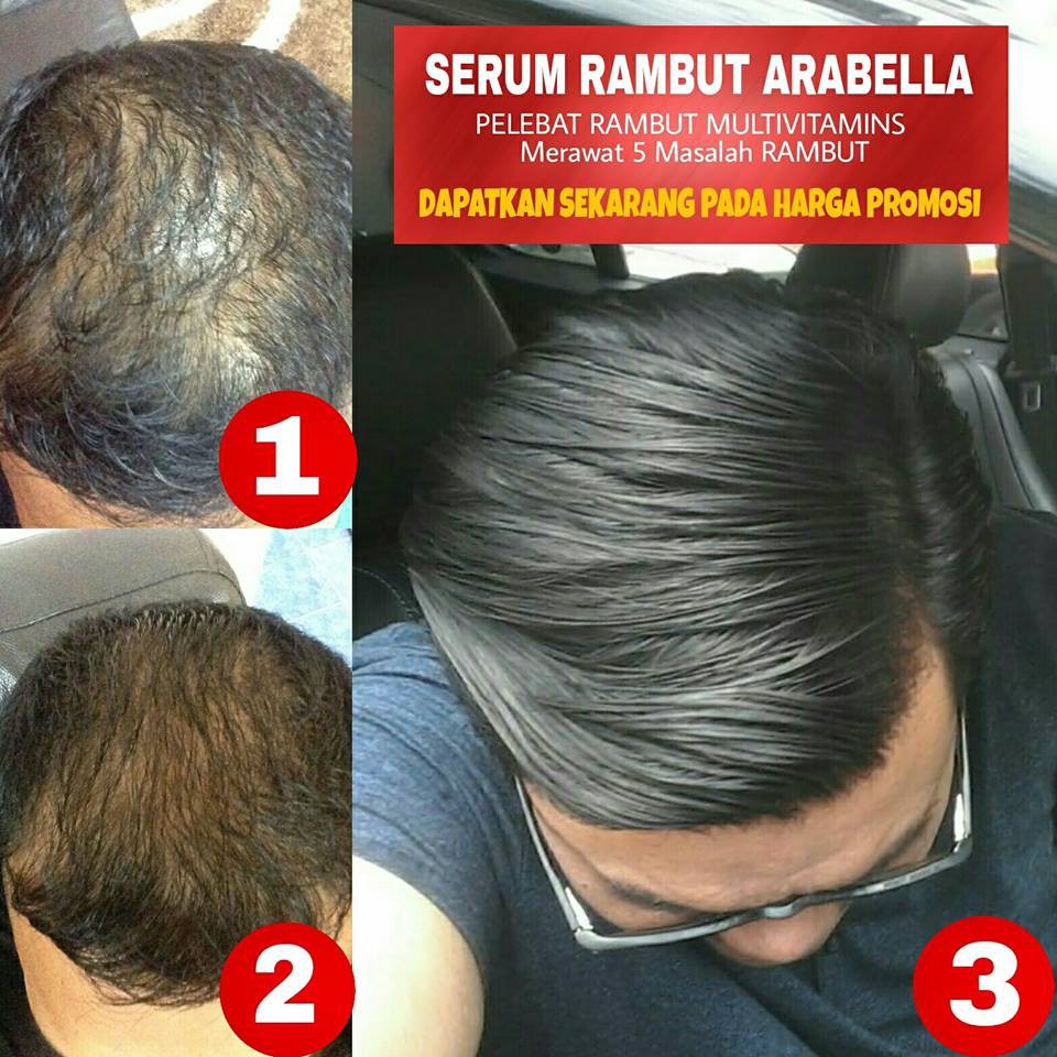 PELEBAT RAMBUT VCO ARABELLA HAIR SERUM (HERBA PENUMBUH RAMBUT JAMBANG ...