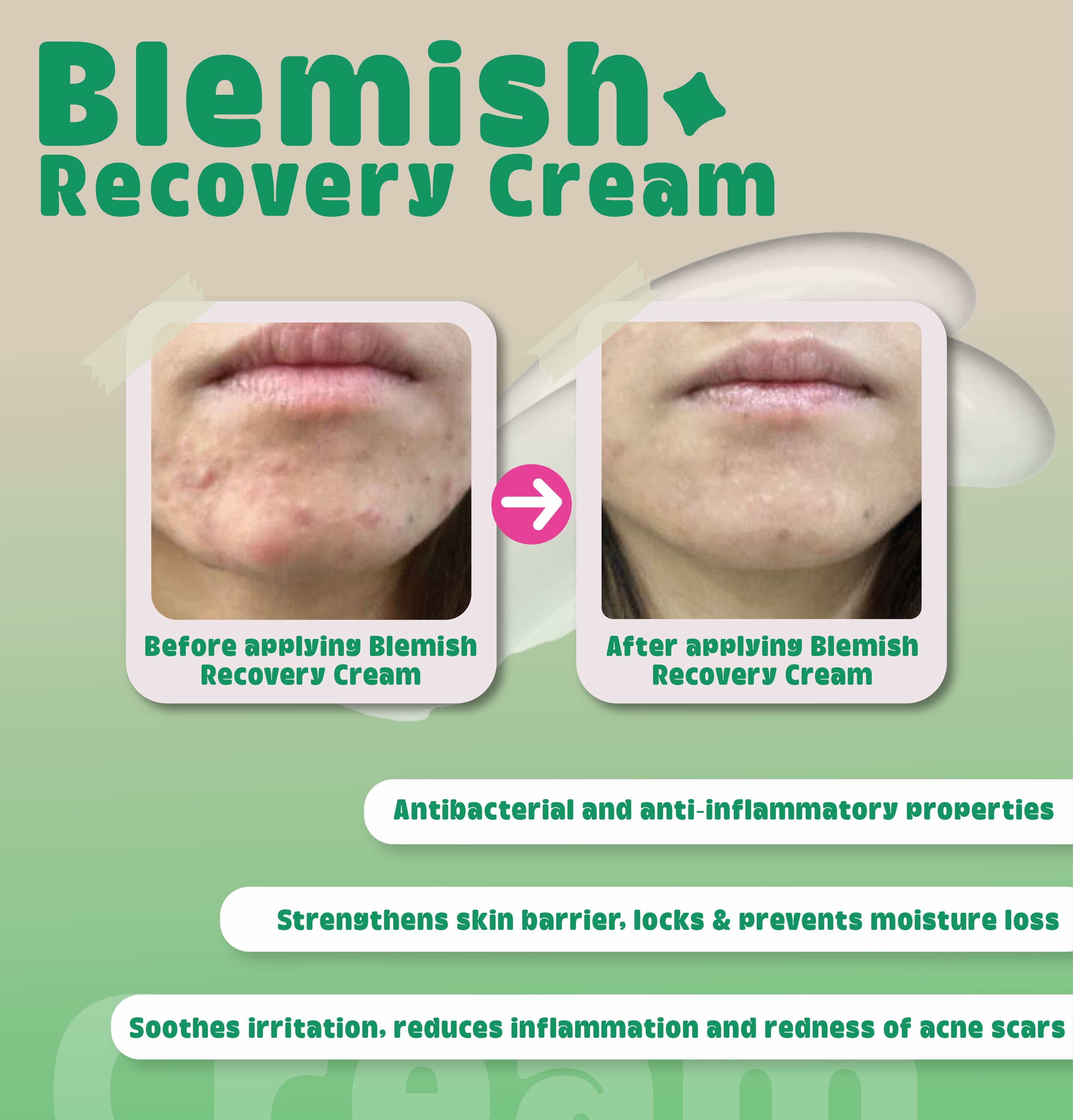 No More Acne Blemish Recovery Cream (30g) Reduce Acne & Scars Repair ...