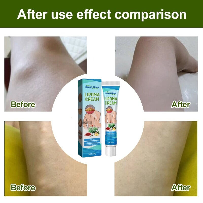 【COD】South Moon Lipoma Removal Cream Lipolysis Fat Lump Relieve Plaster ...