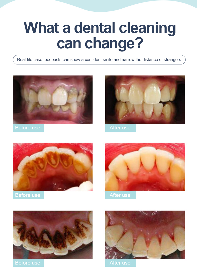 Airuidu M08 Ultrasonic Dental Cleaner Rechargeable Calculus Tartar ...