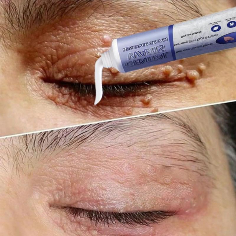Wart remover Ubat buang kutil Skin tag remover Mole Removal Wart Cream ...