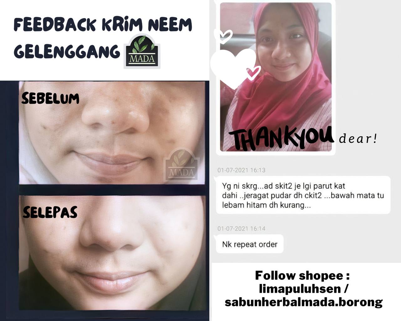 Tanpa steroid Krim herbal neem gelenggang untuk masalah gatal kulit ...