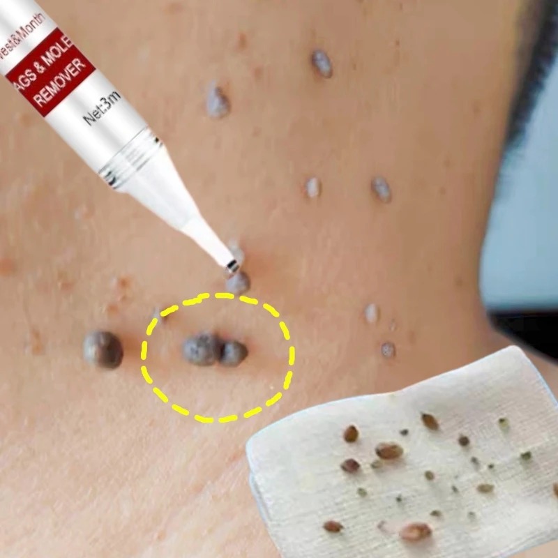 Ubat Buang Kutil ubat ketuat kutil ketuat tahi lalat biji kolestrol ...