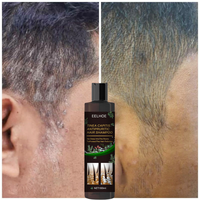 anti dandruff shampoo Syampoo kelemumur psoriasis shampoo scalp ...