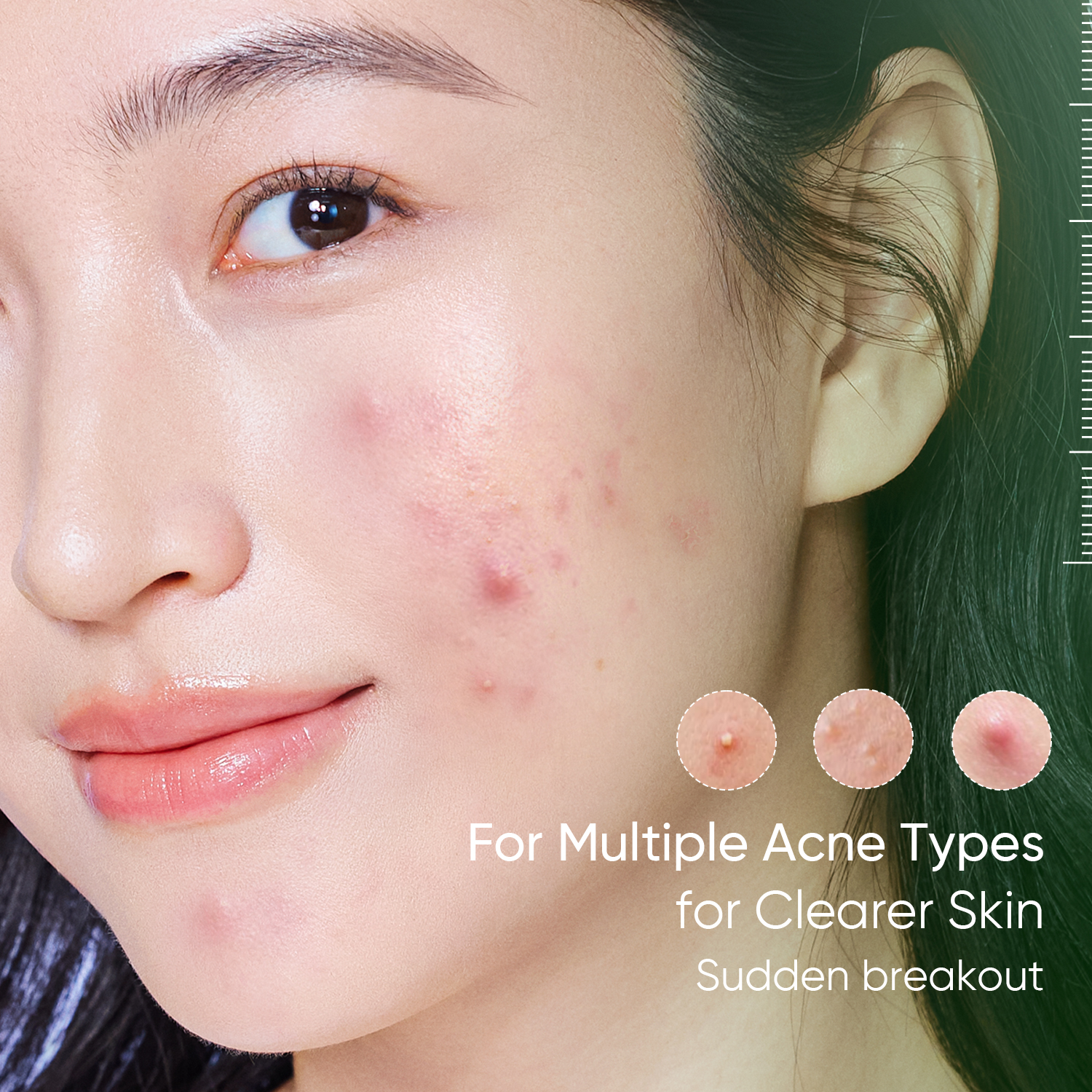 【AntiAcne】SKINTIFIC Acne Drying Lotion Salicylic Acid Acne spot ...