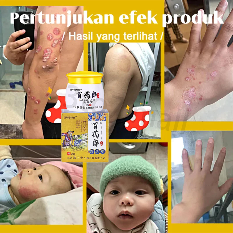 ubat gatal kulit ubat kurap antifungal eczema cream psoriasis ointment ...