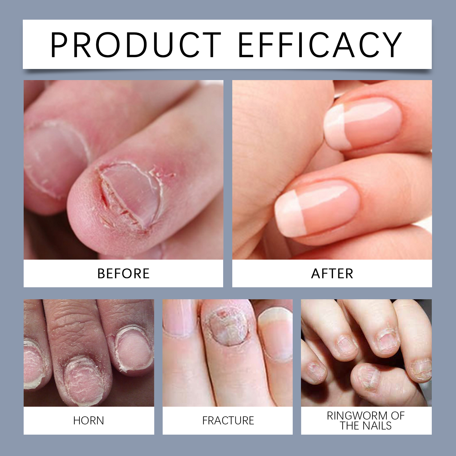 Wiyun Paronychia Removal Oil 10ml Paronychia Treatment Oil ...