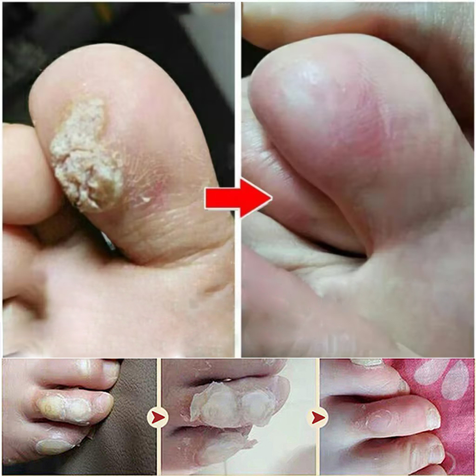 Ubat Ketuat Tapak Kaki Foot Corn Remover Corn Caps corn plaster remover ...
