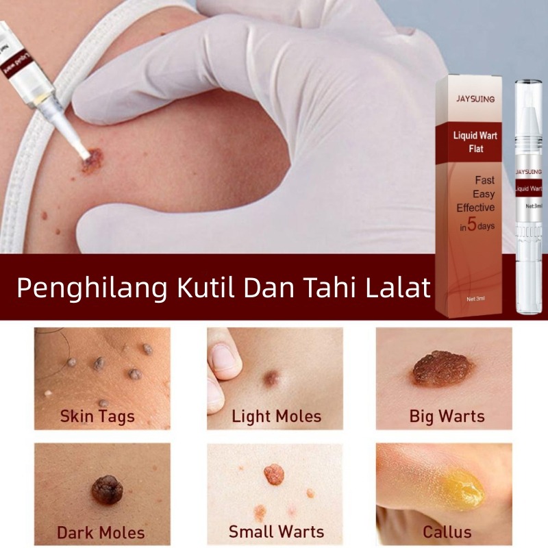 Ubat Buang Kutil ubat ketuat kutil ketuat tahi lalat biji kolestrol ...