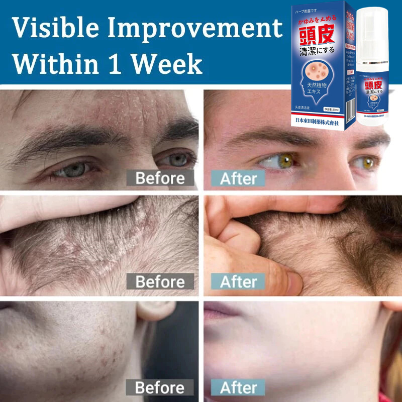Scalp treatment Hair follicle spray relieve folliculitis Seborrheic ...