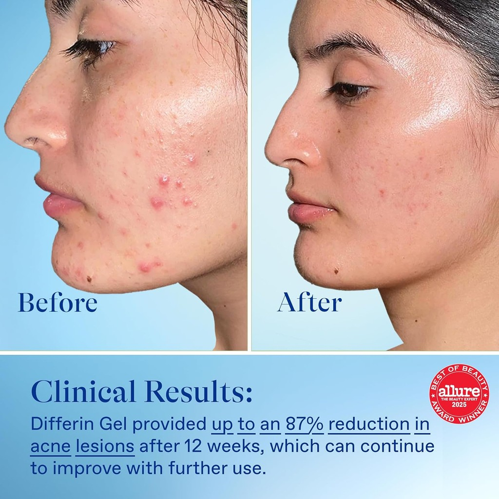 Differin Acne Gel | 30-Day Retinoid Treatment for Face | Gentle on ...