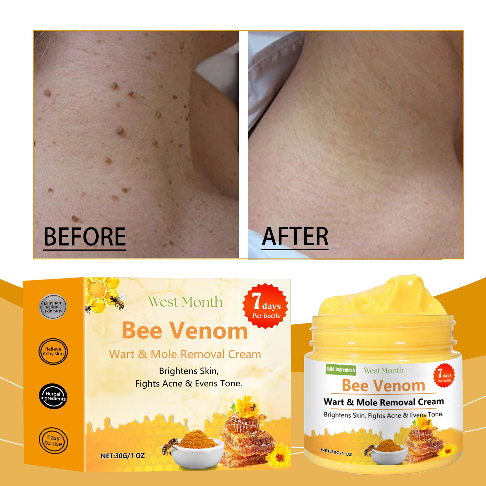 Bee Venom Wart Removing Cream 30g Wart Removal Cream Relieve Wart Itch ...