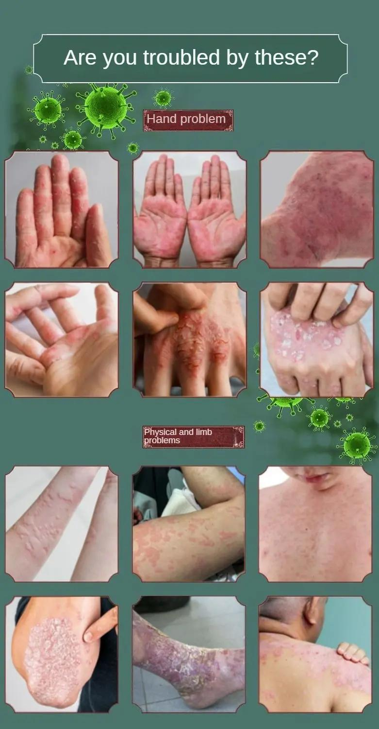 【Buy3Free2-get 5Pcs】Baiyaolang Cream 20g Krim Herba | Gatal, Ruam ...