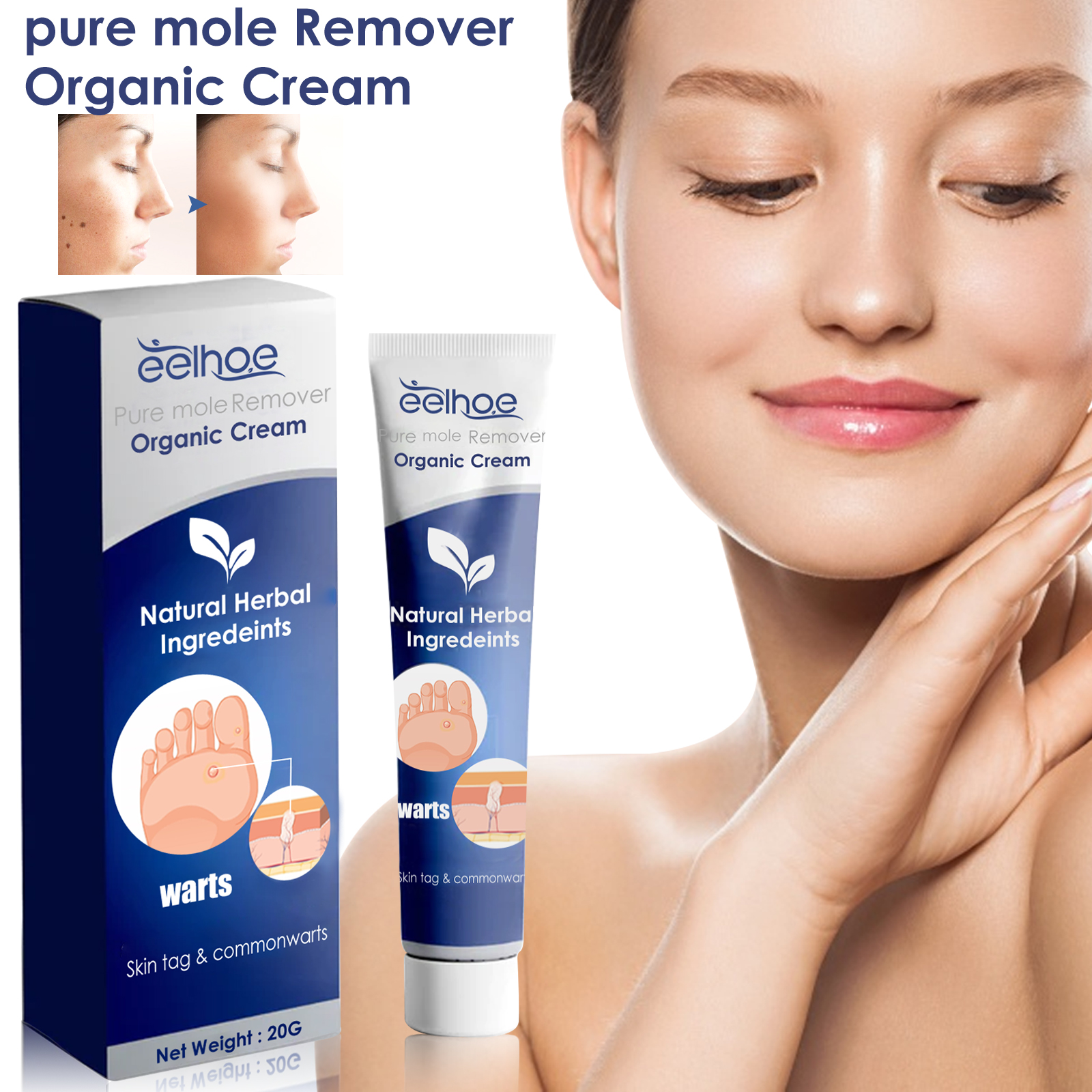 Mole Remover Organic Cream 20g Mole Remover Cream Skin Tag Remover ...