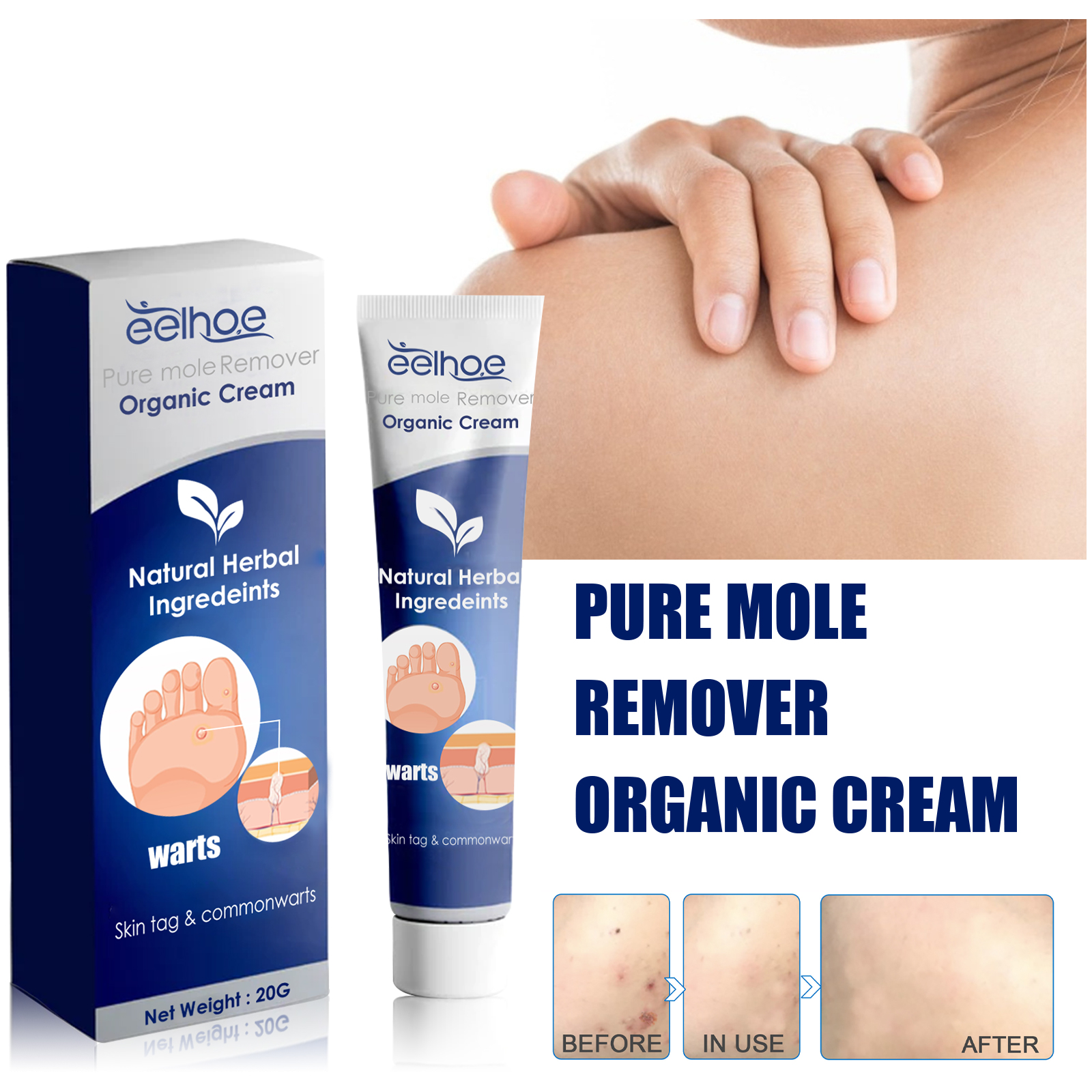 Mole Remover Organic Cream 20g Mole Remover Cream Skin Tag Remover ...