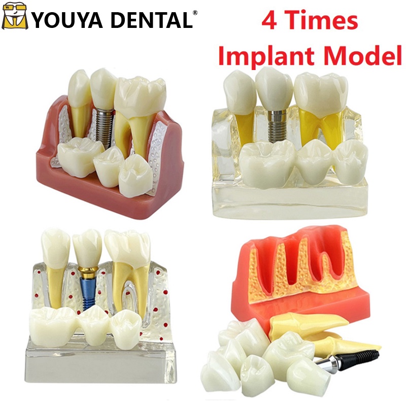 Transparent Dental Model Resin 4times Tooth Implant Model For Studying ...
