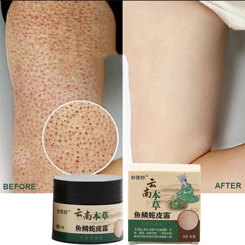 Repair Chicken Skin Cream Curing Body Dark Spot Keratosis Follicle ...