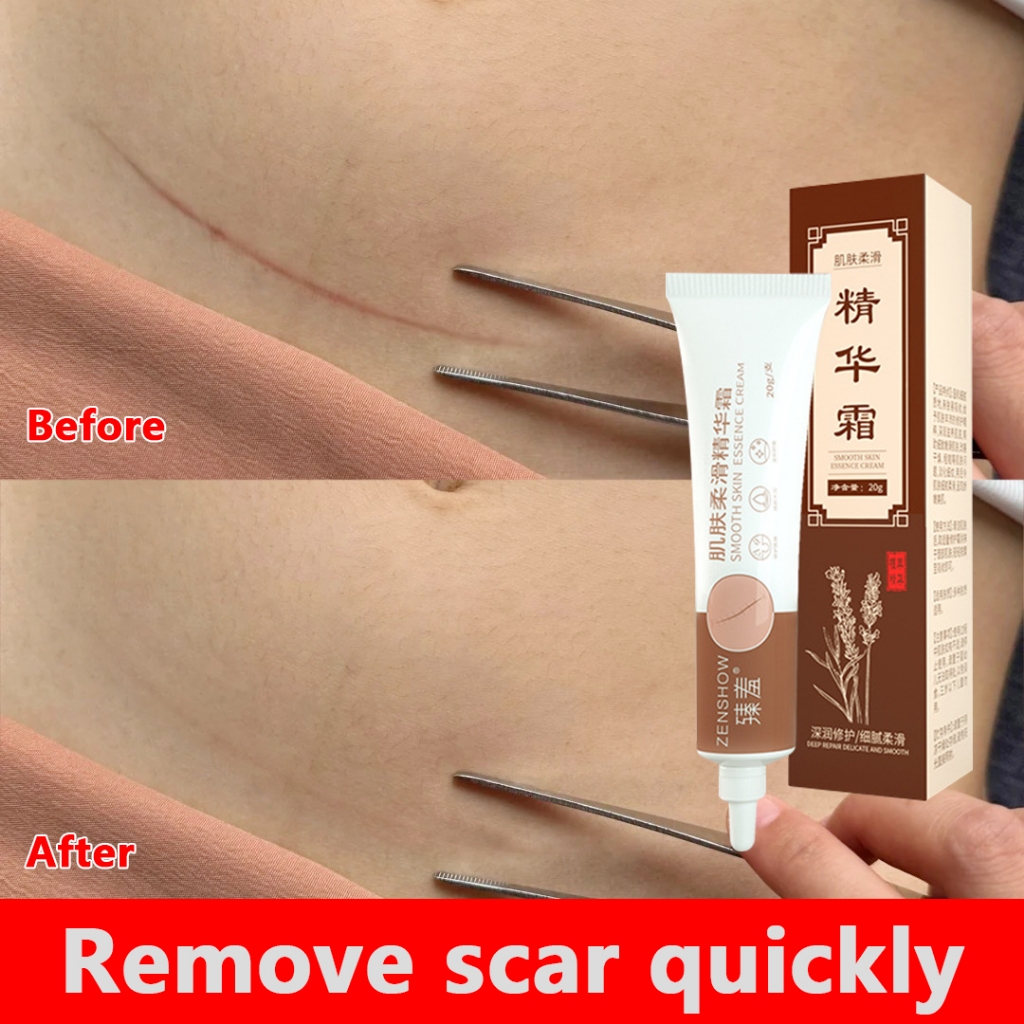 Scar Repair Cream Scar Removal Ac-ne Marks Smoothing Whitening ...