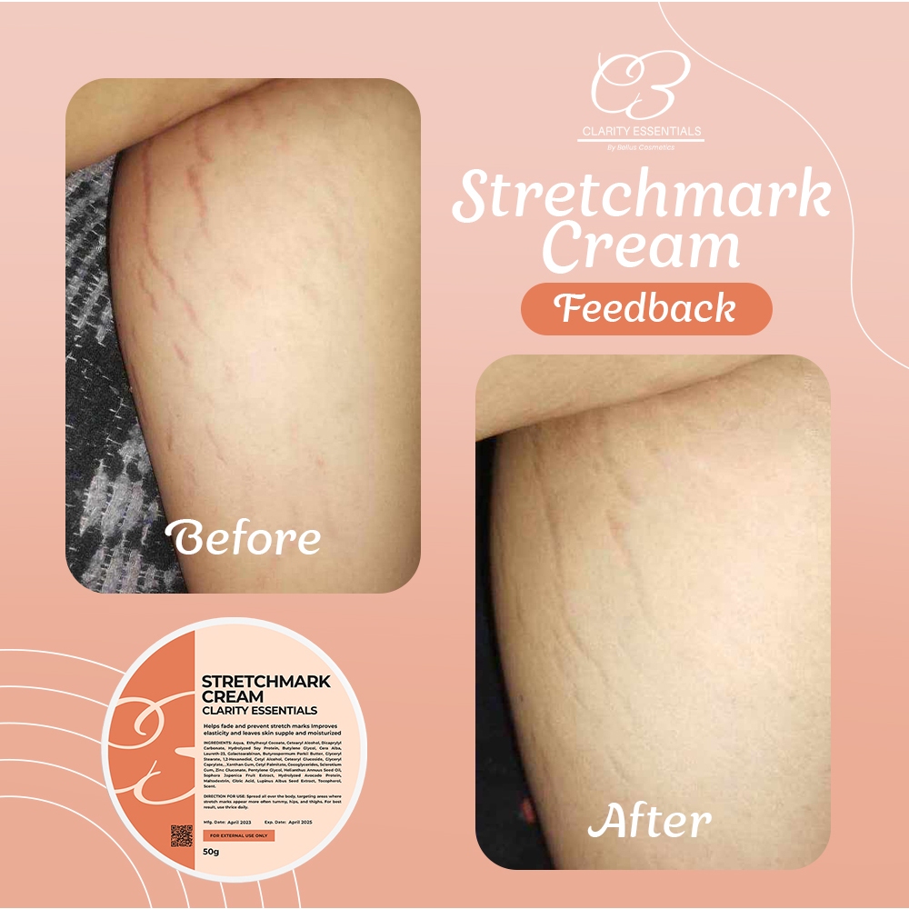 Stretch Mark Remover Cream - Clarity Essentials | Shopee Malaysia