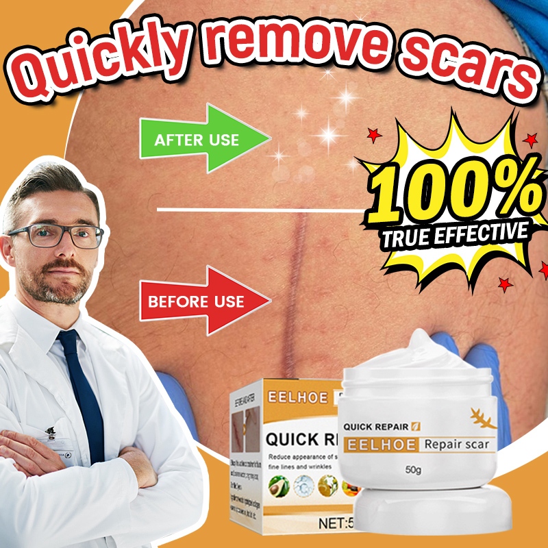 Acne Scar Remover Old Scar Scarminator Cream Strech Mark Remover Scar ...
