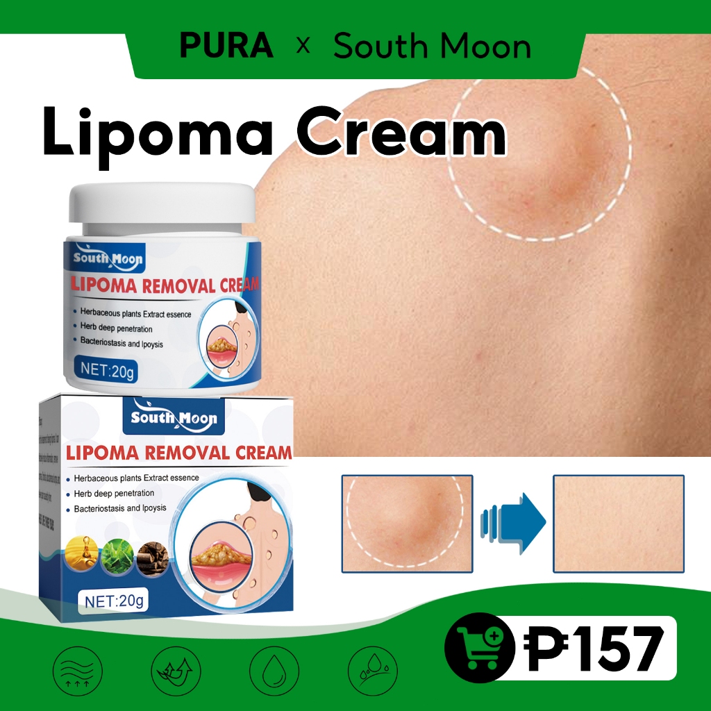 South Moon Lipoma Removal Cream 20g Lymphatic Cream Lymphoma Remover ...