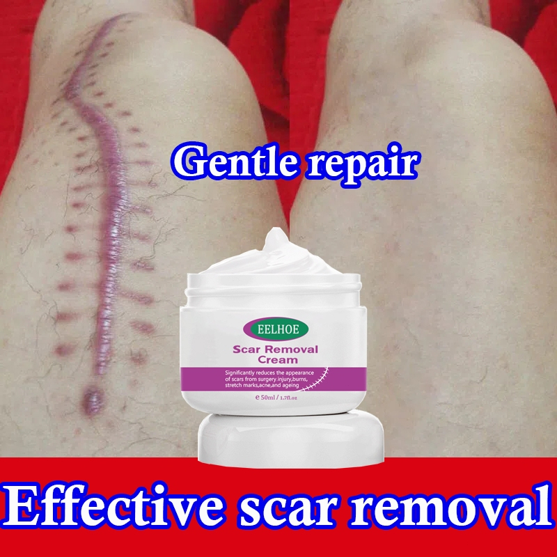 Scar Removal Cream Anti Stretch Mark Cream Acne Scar Skin Repair Old ...