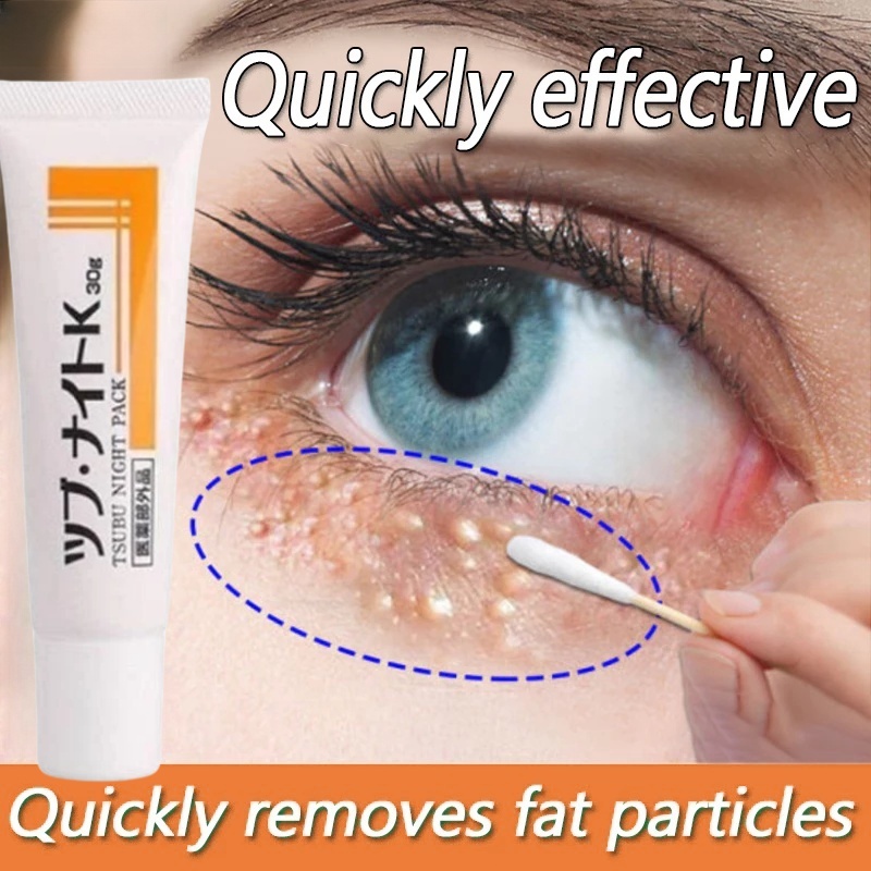 Milia Removal Cream Fat Granules Removal Eye Cream Warts Remover 30G ...