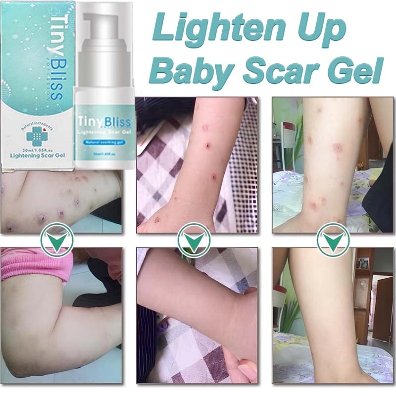 TinyBliss Lighten Up Lightening Baby Scar Gel Scar Remover Cream For ...