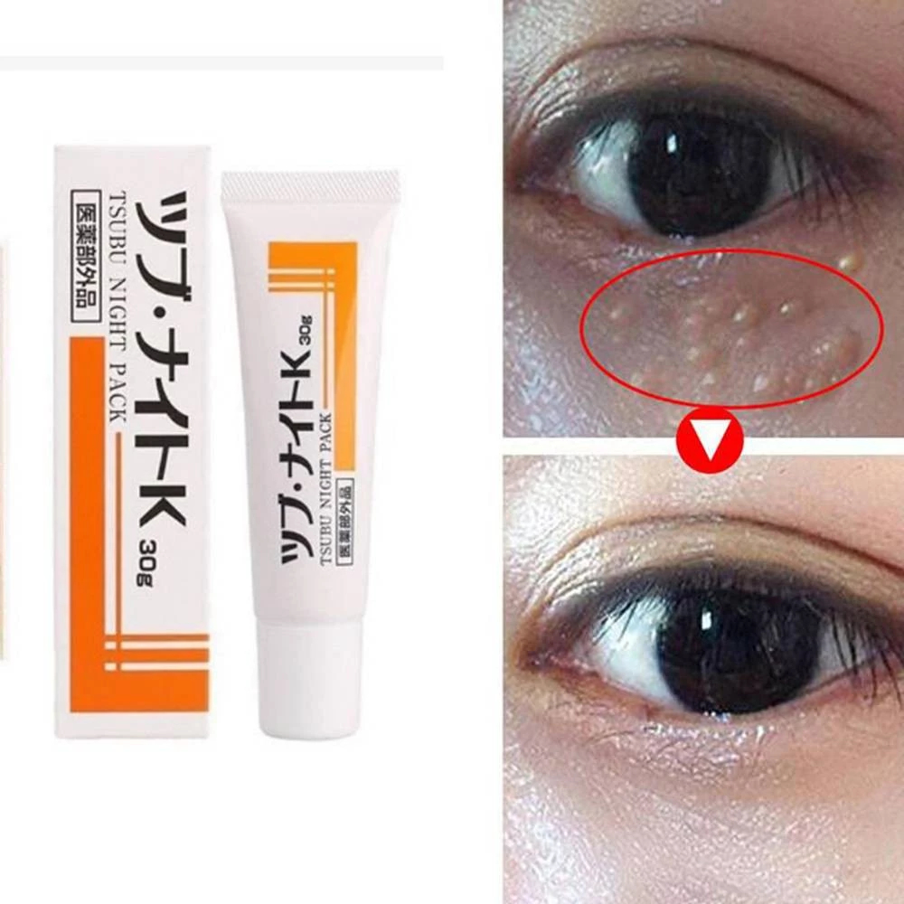 Milia Removal Eye Cream Milia Remover Cream Warts Remover Cream Remove ...