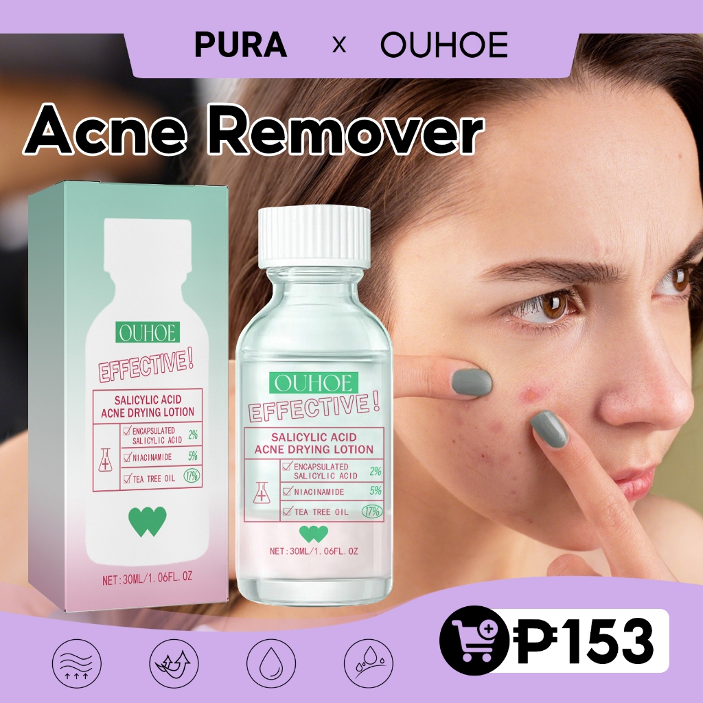 OUHOE Salicylic Acid Acne Drying Lotion 30ml Pimple Warrior Salicylic ...