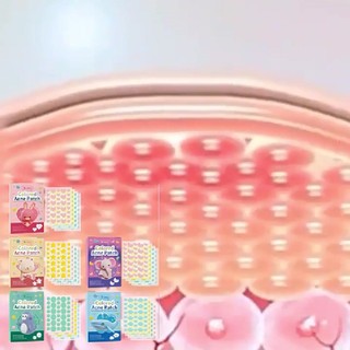Big Zit Patches 144pcs Pimple Remover for Zit Absorbing Skin-Friendly ...