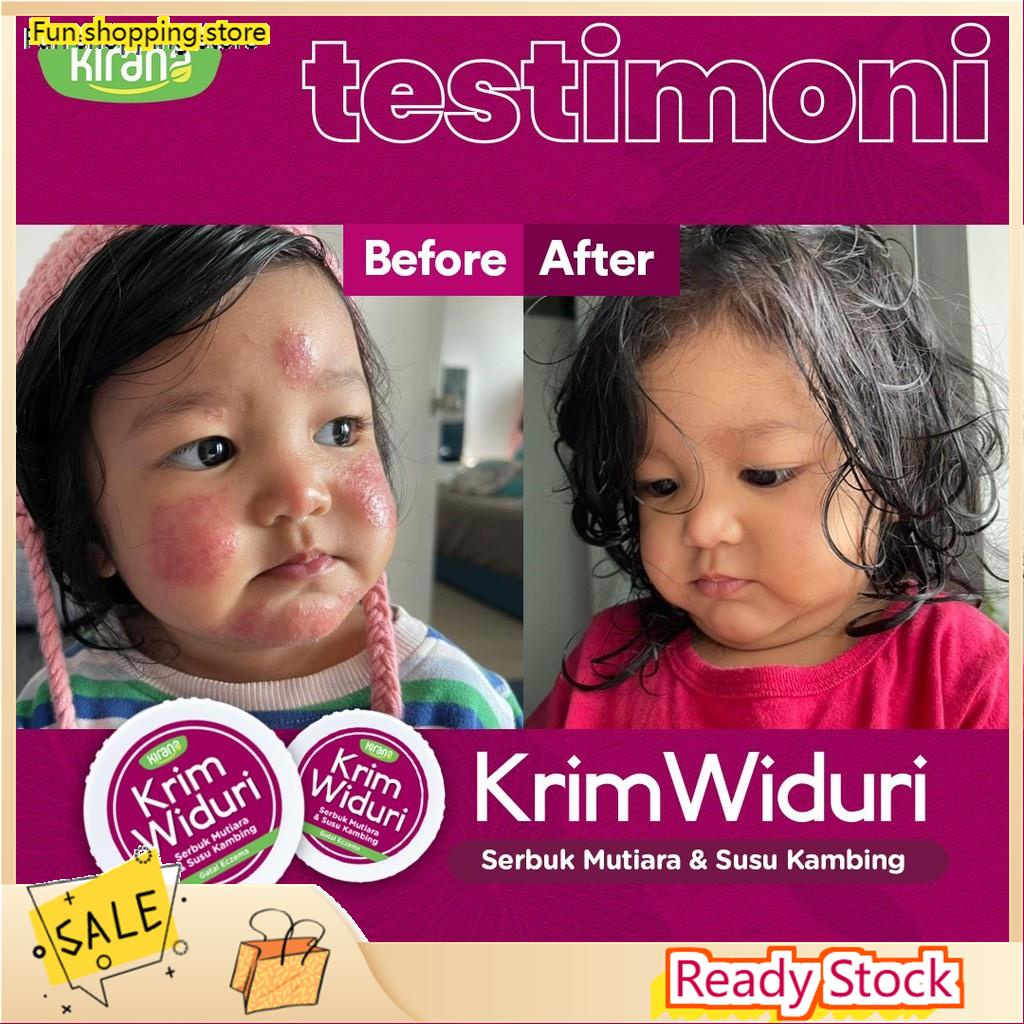 Chandra_SHOP[RECOMMENDED]WIDURI Psoriasis Eczema Cream Antifungal ...